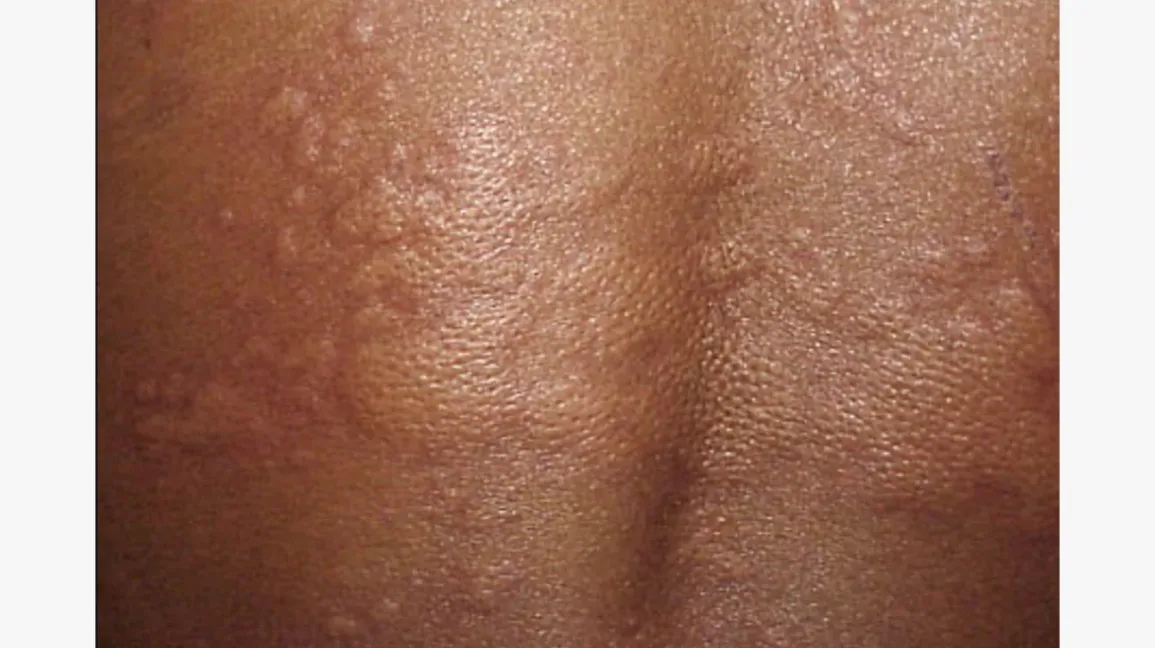 Urticaria (Hives) - Medicobridge - Patient Information